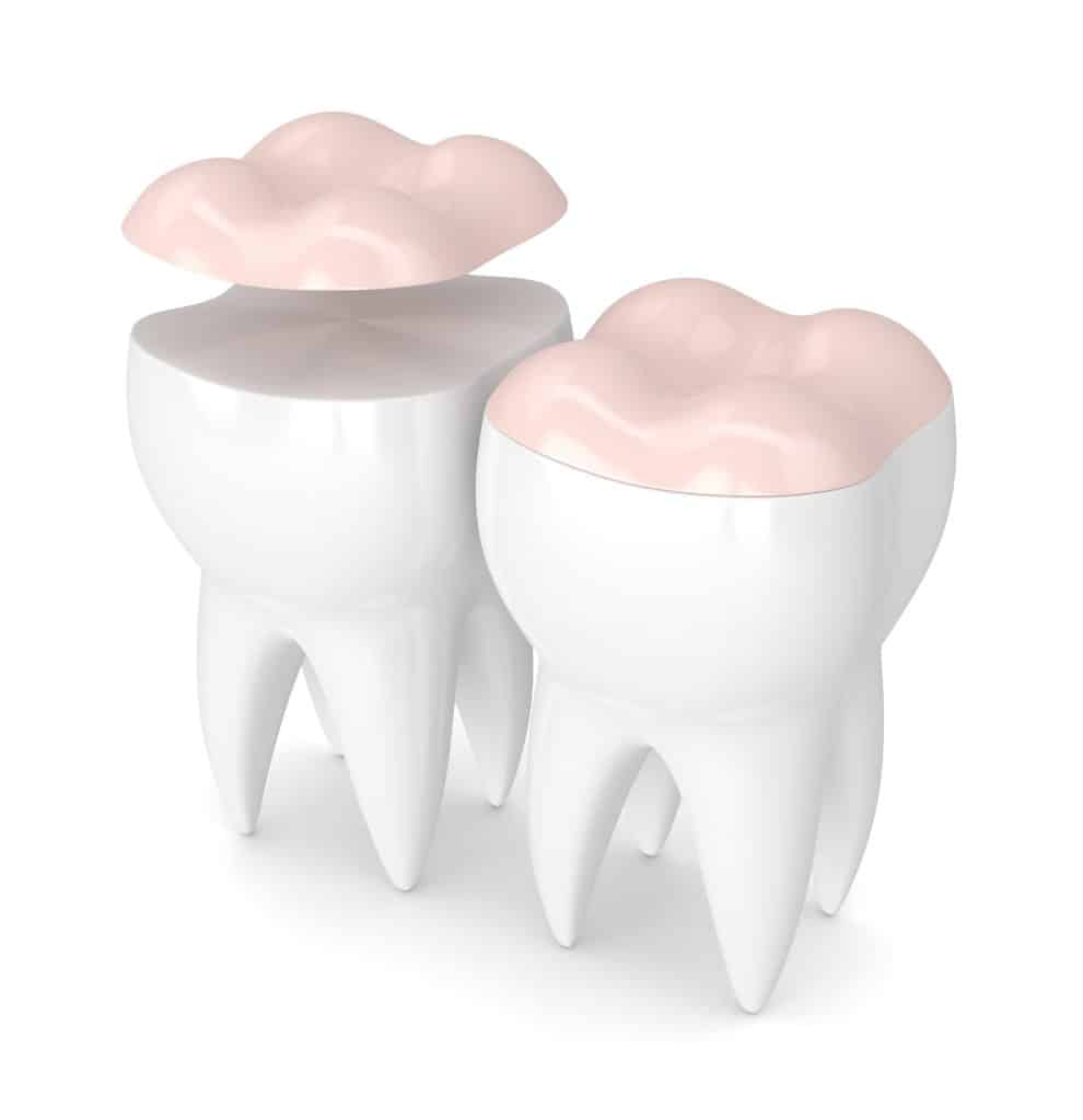 Understanding The Difference Between Inlays And Onlays